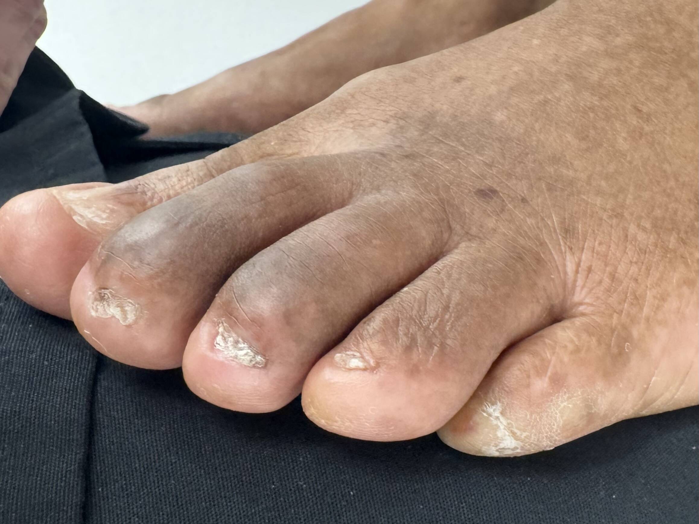 Hammertoe Before and After Photos | Northwest Surgery Center