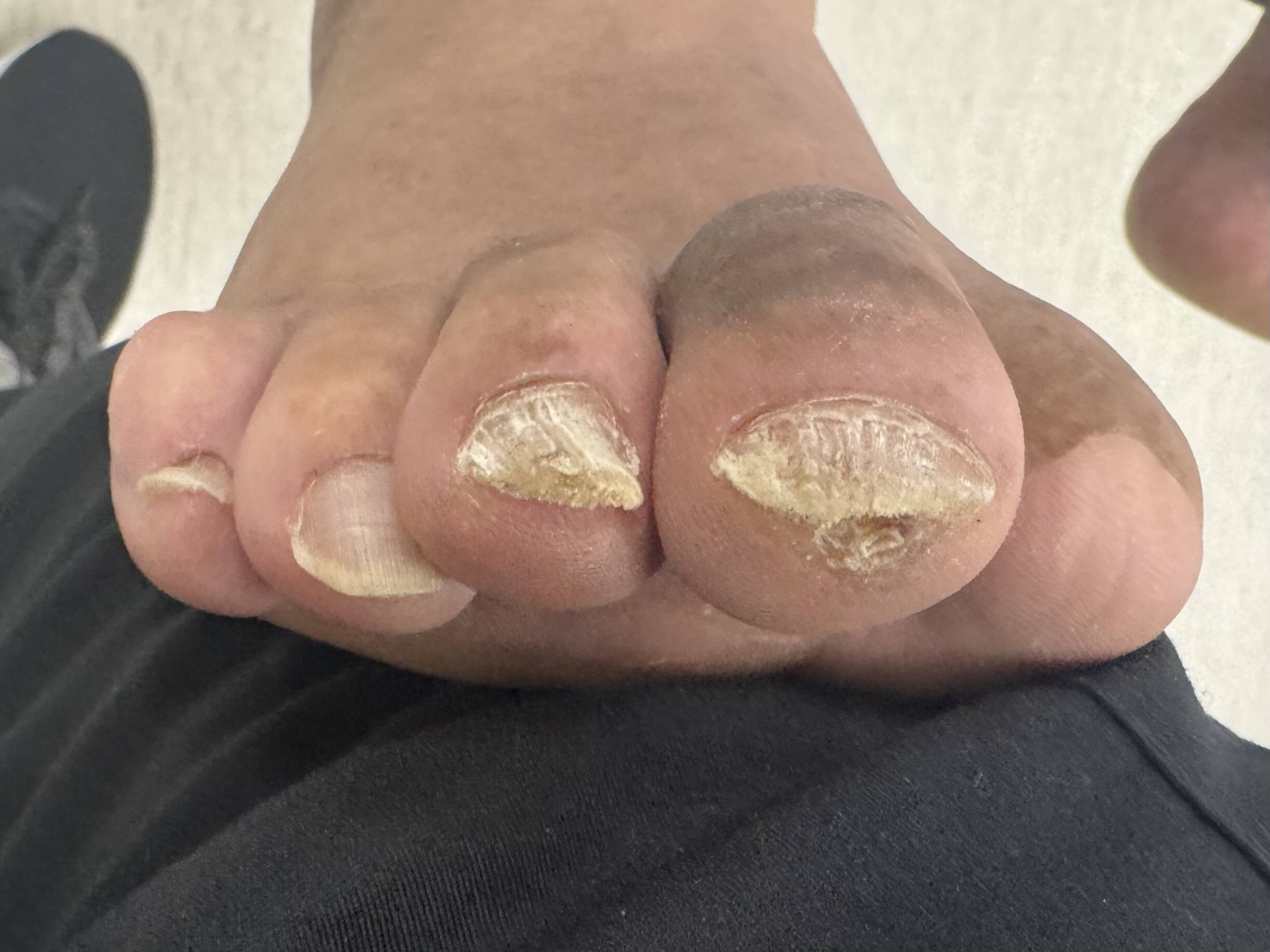 Mallet Toe Before and After Photos | Northwest Surgery Center