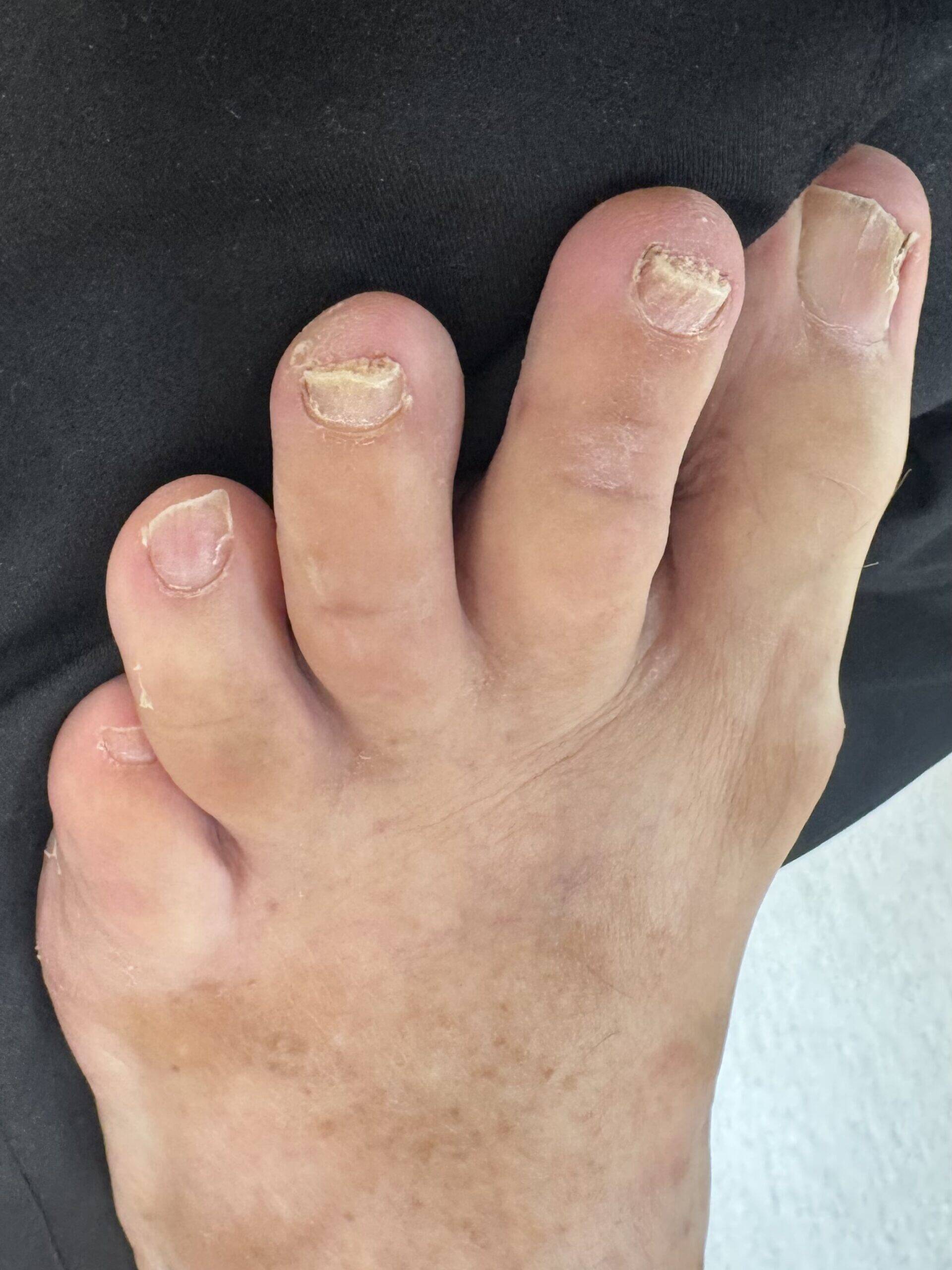 Hammertoe Before and After Photos | Northwest Surgery Center
