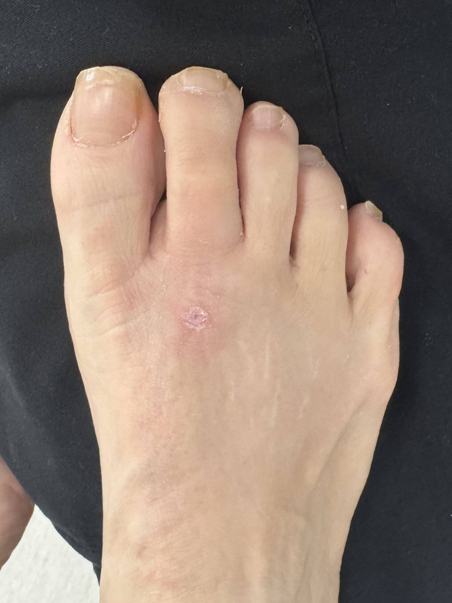 Hammertoe Before and After Photos | Northwest Surgery Center