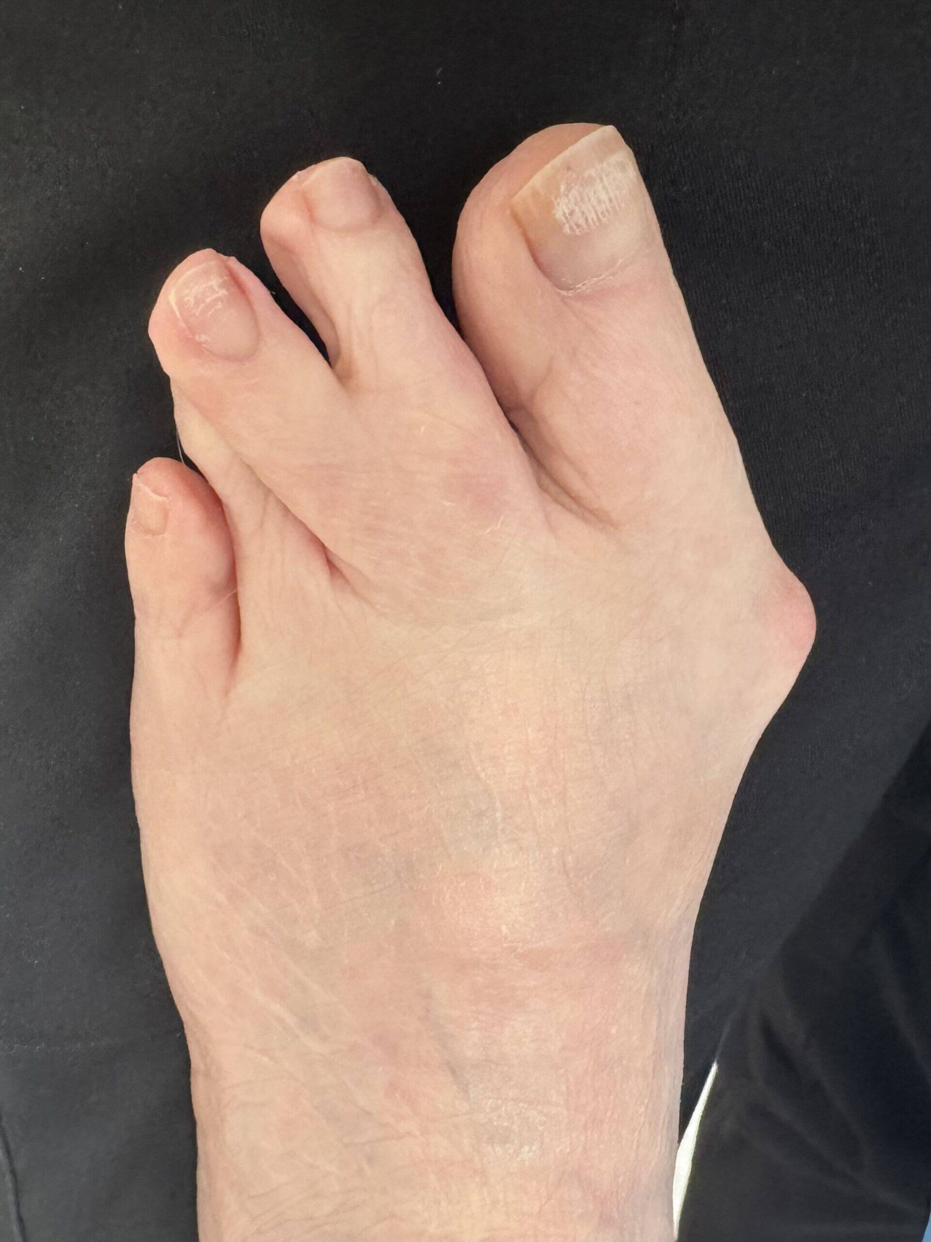 Hammertoe Before and After Photos | Northwest Surgery Center