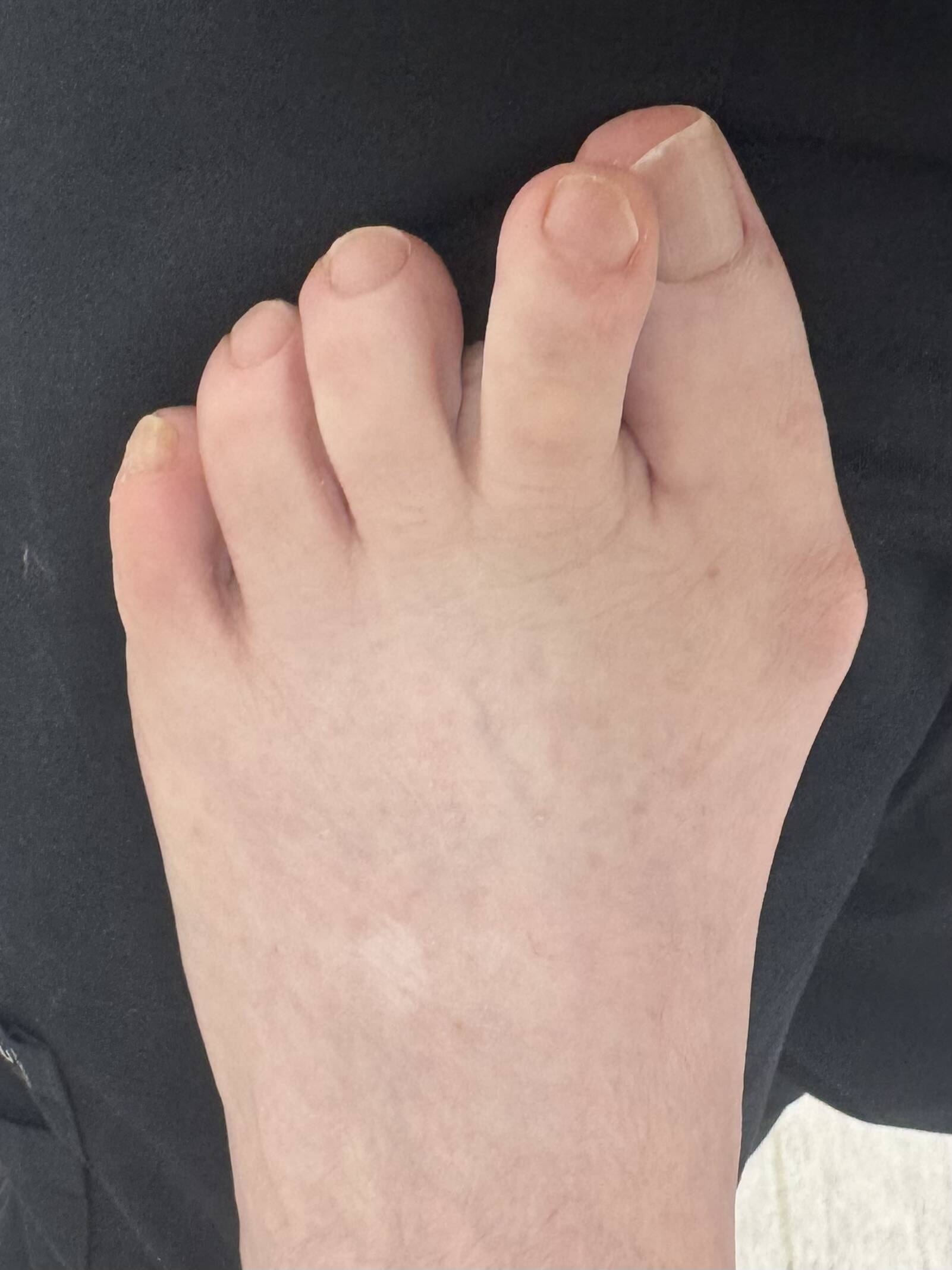 Hammertoe Before and After Photos | Northwest Surgery Center