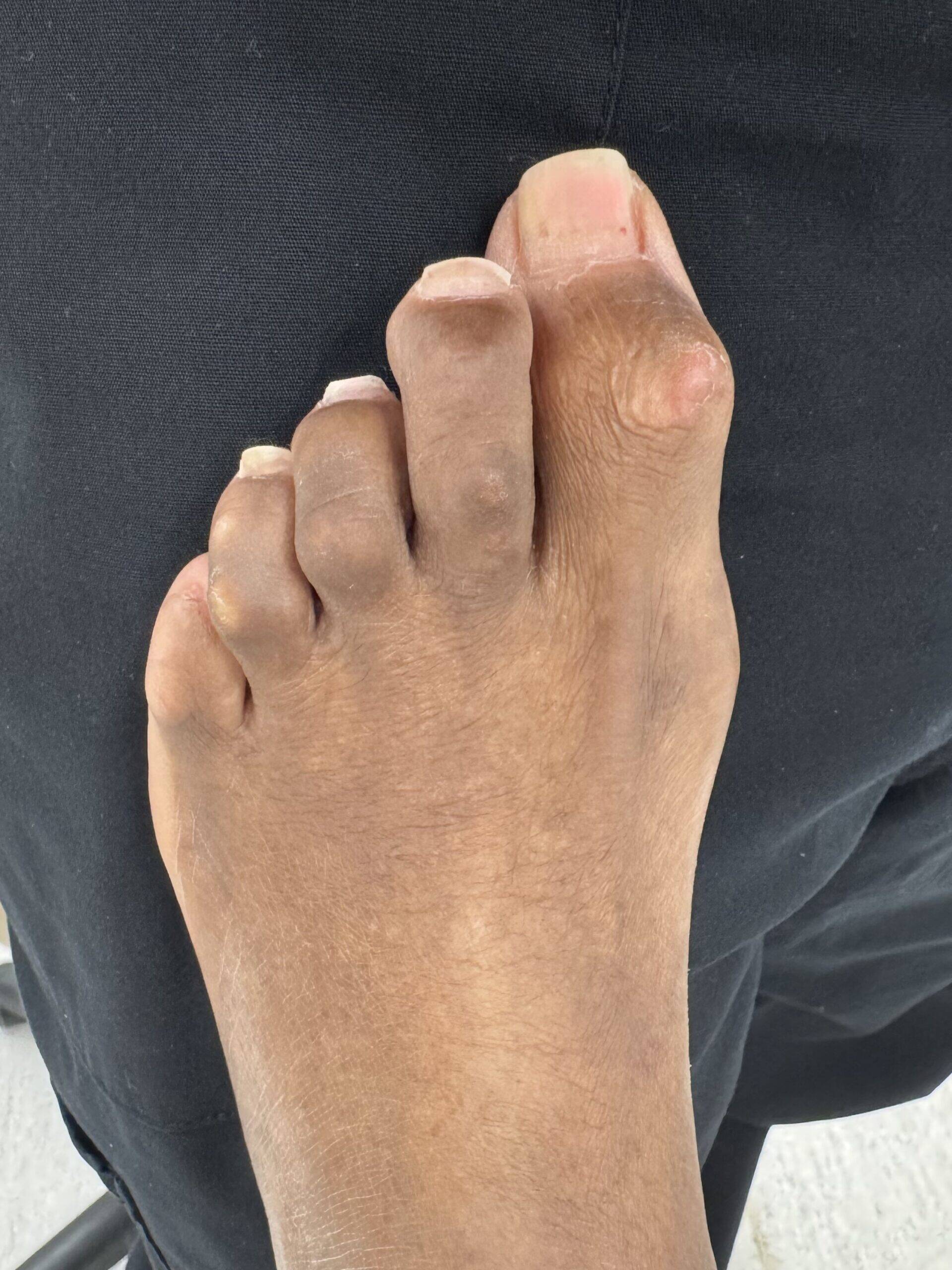 Hammertoe Before and After Photos | Northwest Surgery Center