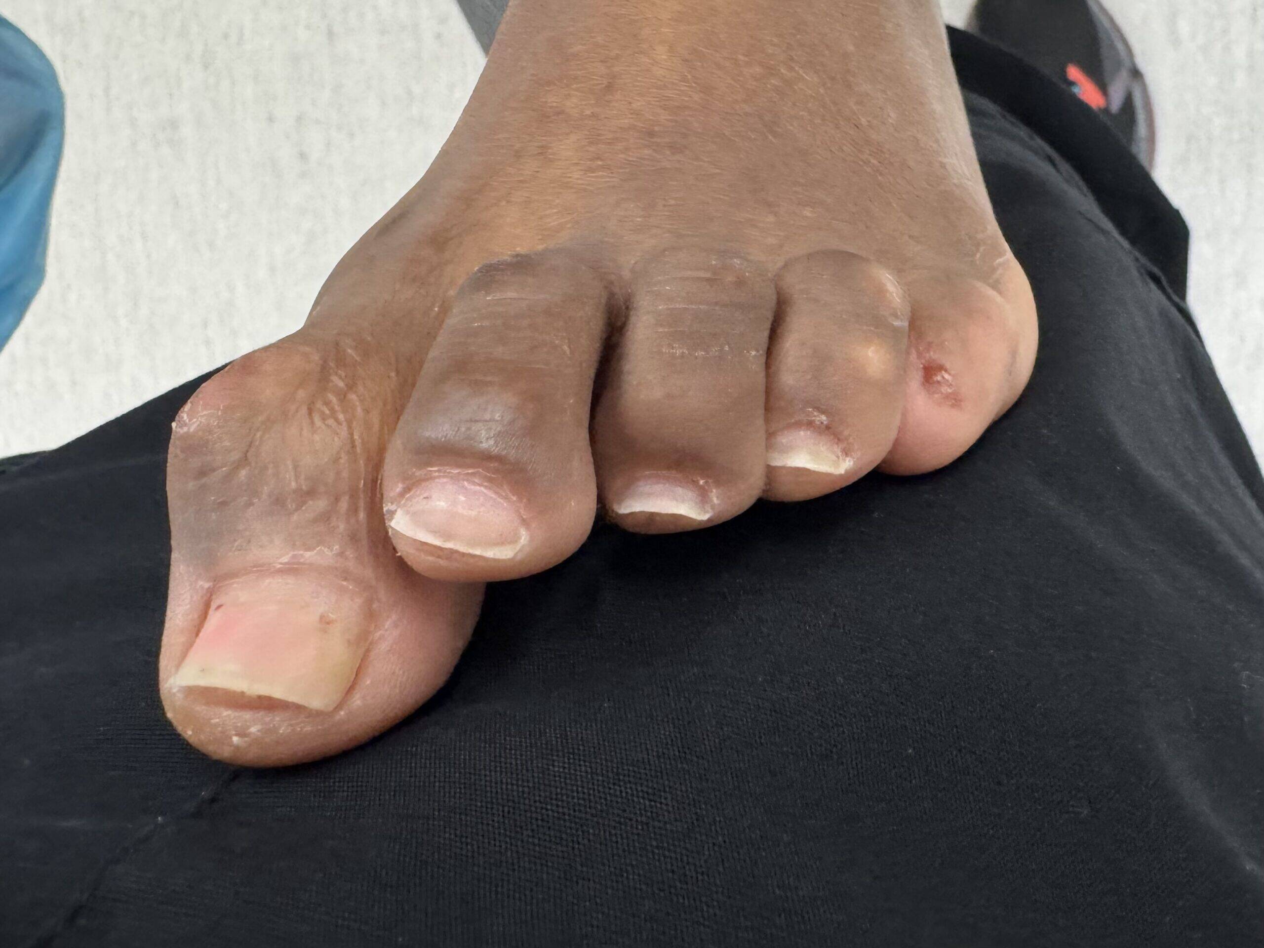 Hammertoe Before and After Photos | Northwest Surgery Center