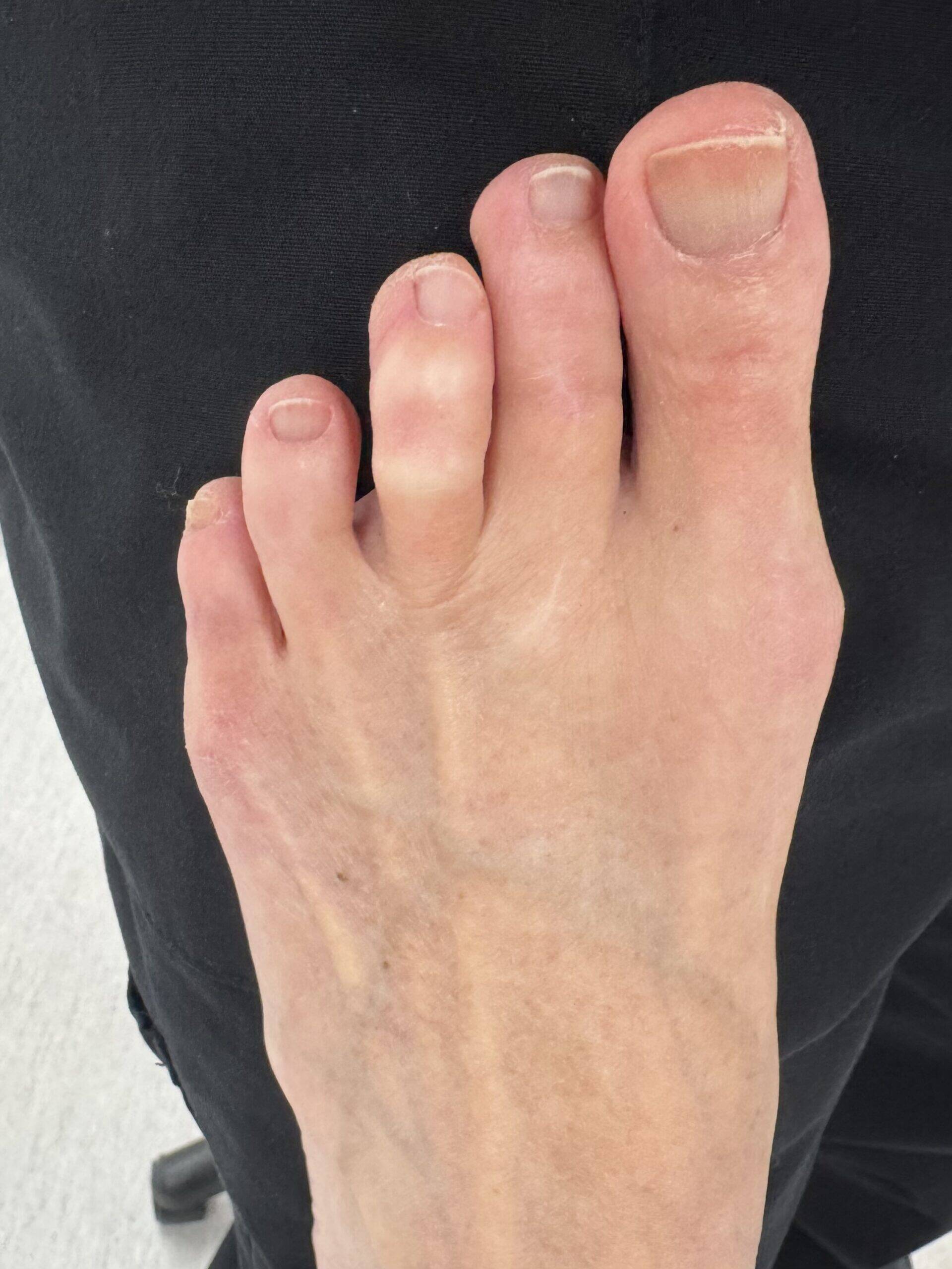 Hammertoe Before and After Photos | Northwest Surgery Center