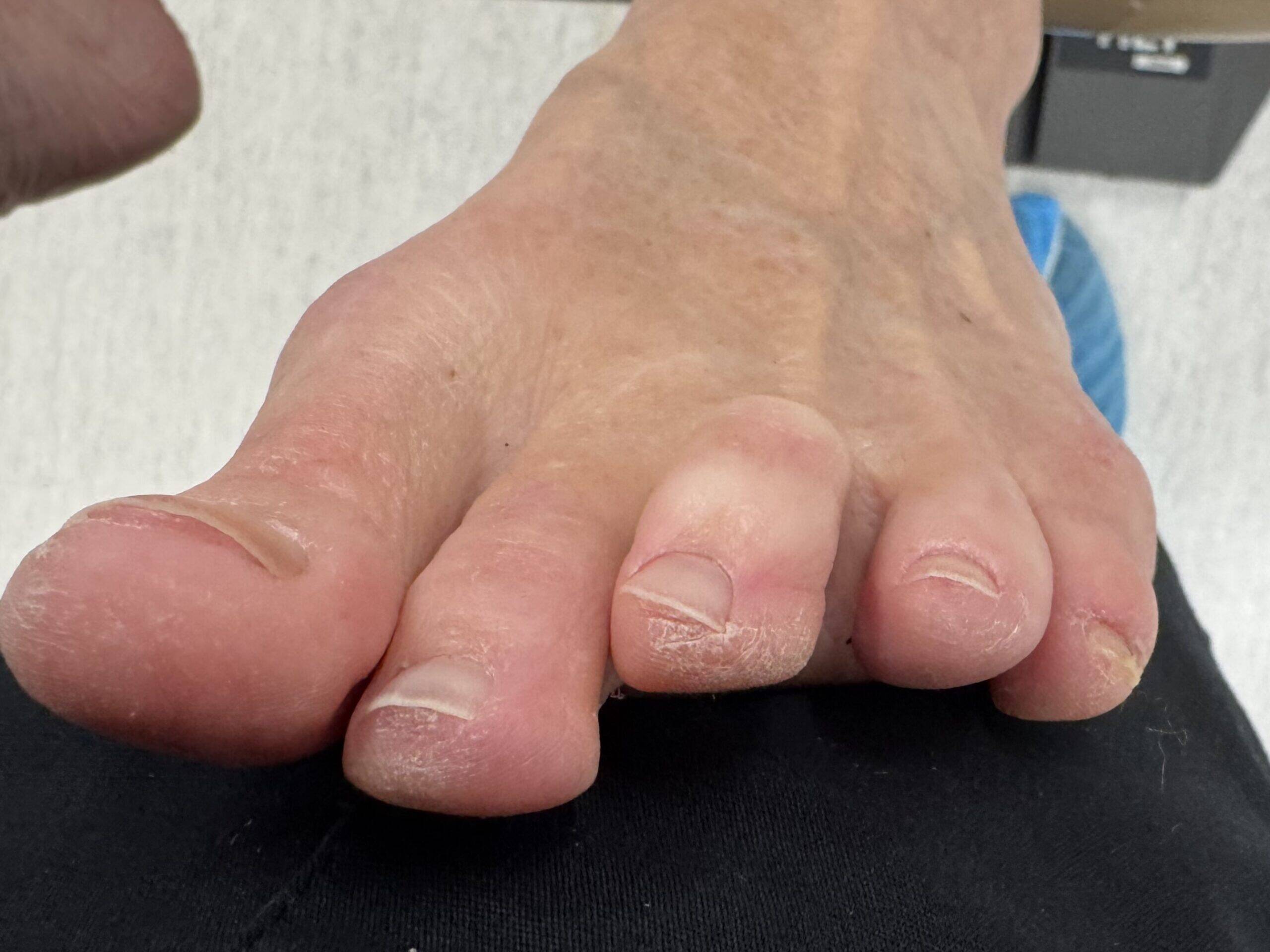 Hammertoe Before and After Photos | Northwest Surgery Center