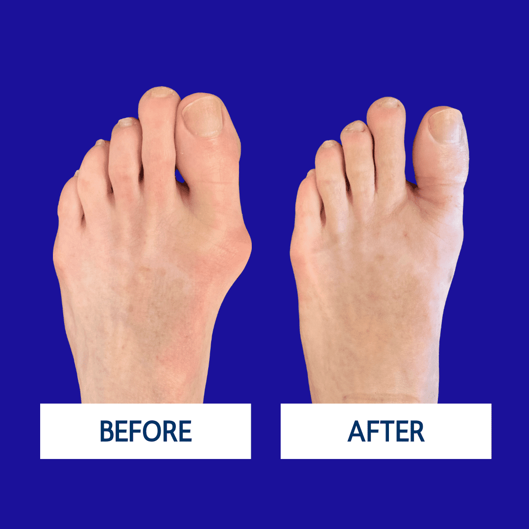Bunion Surgery Before and After Photos | Northwest Surgery Center