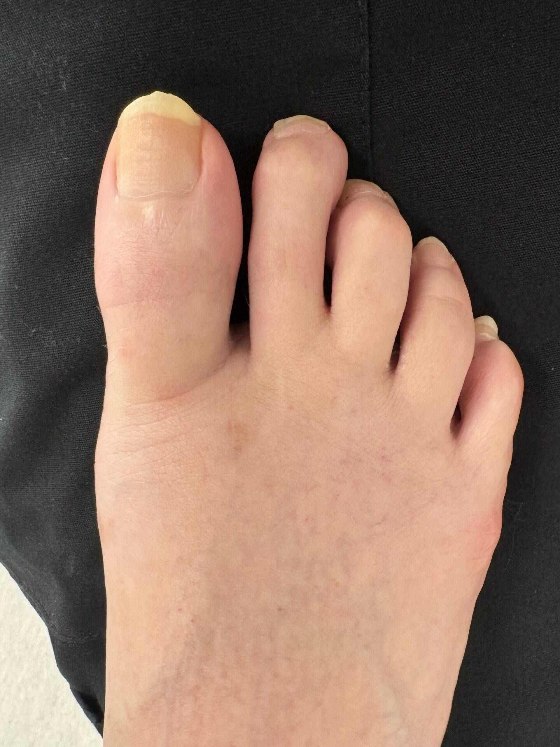 Mild Bunion Before and After Photos | Northwest Surgery Center
