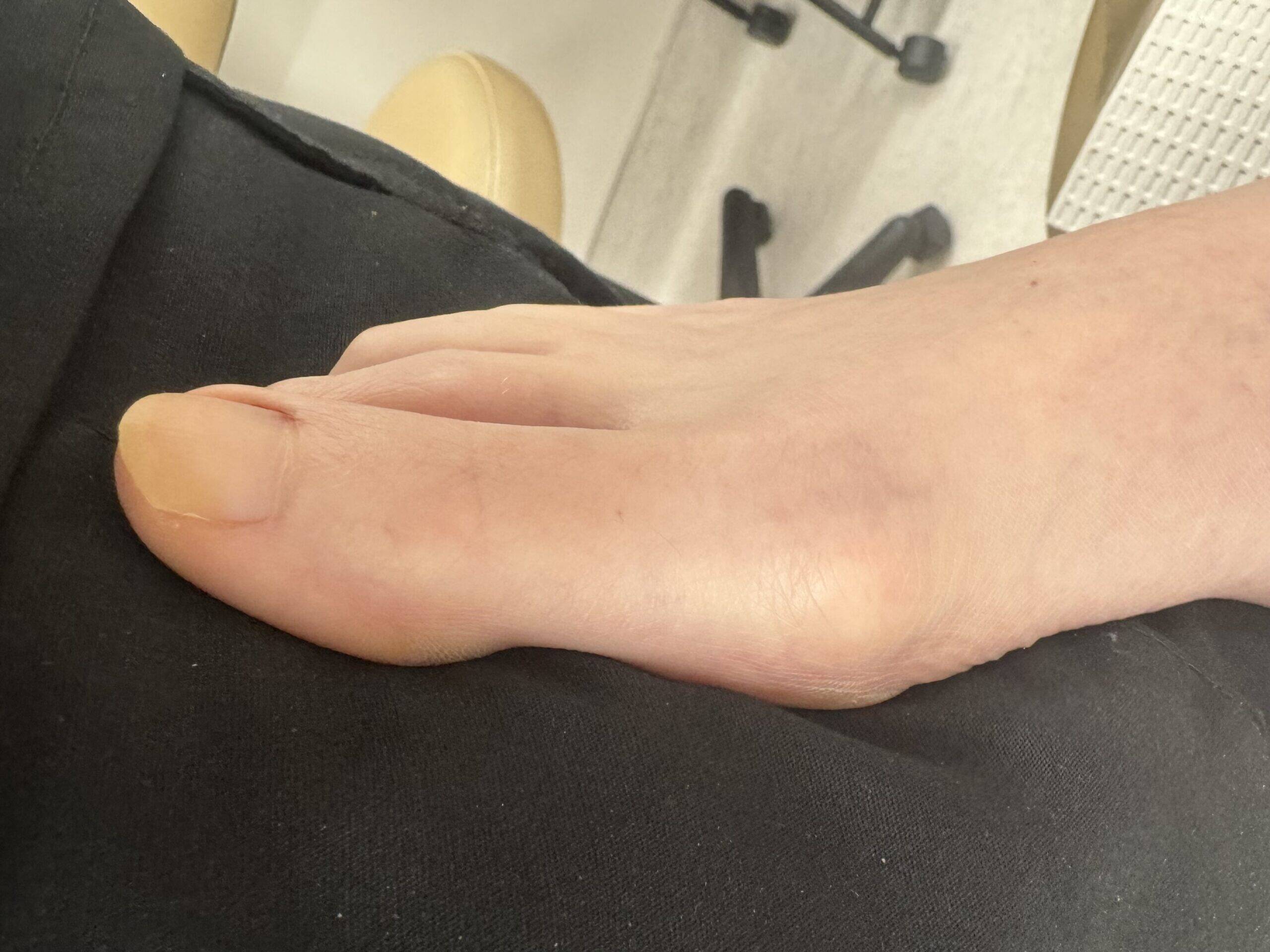 Mild Bunion Before and After Photos | Northwest Surgery Center