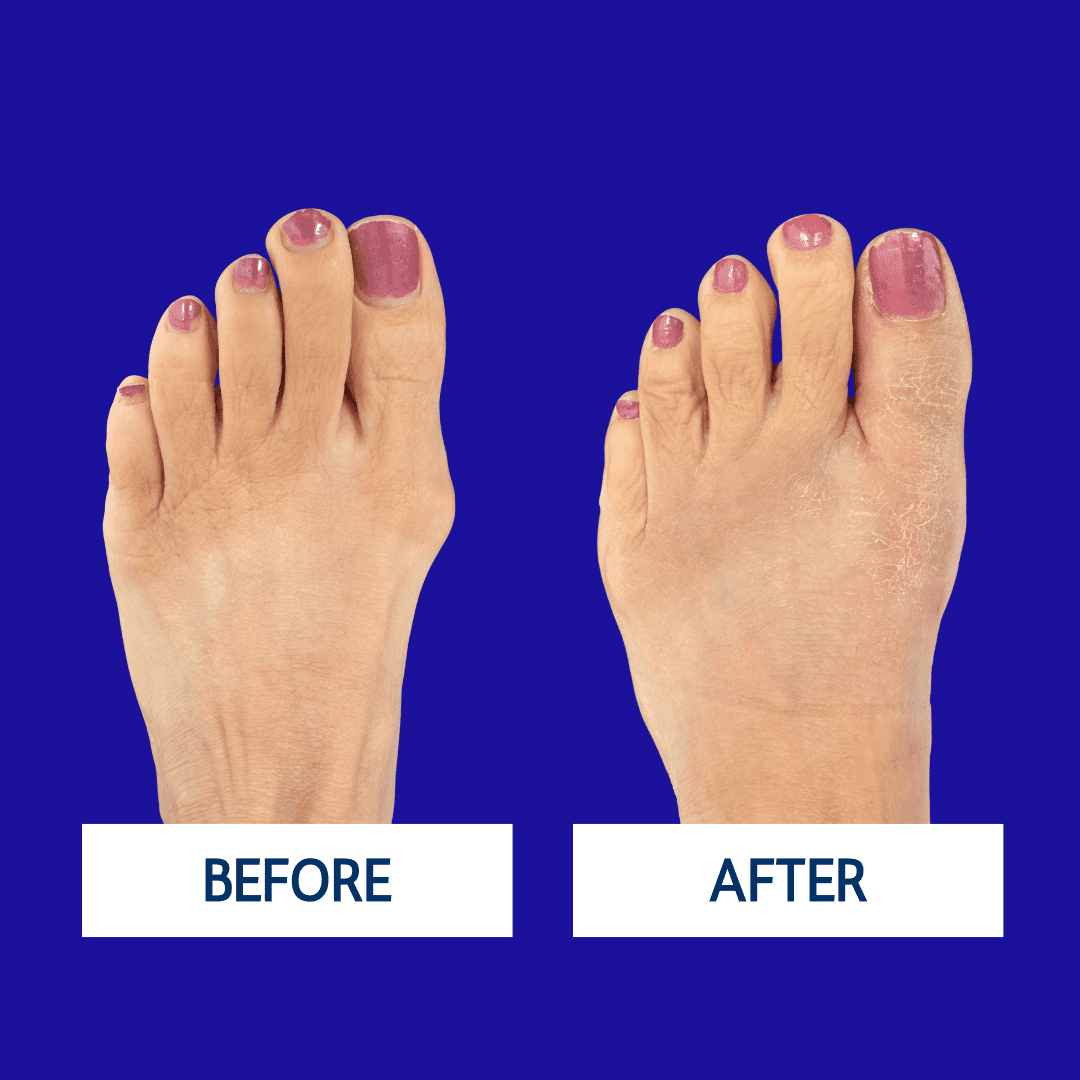 Bunion Surgery Before and After Photos | Northwest Surgery Center