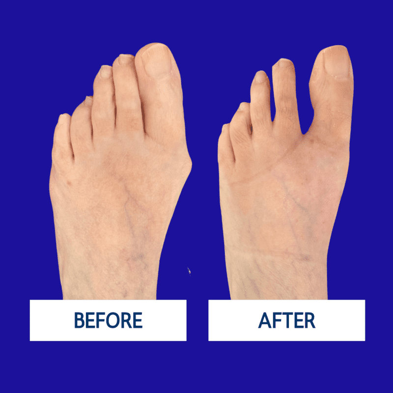 Bunion Surgery Before and After Photos | Northwest Surgery Center