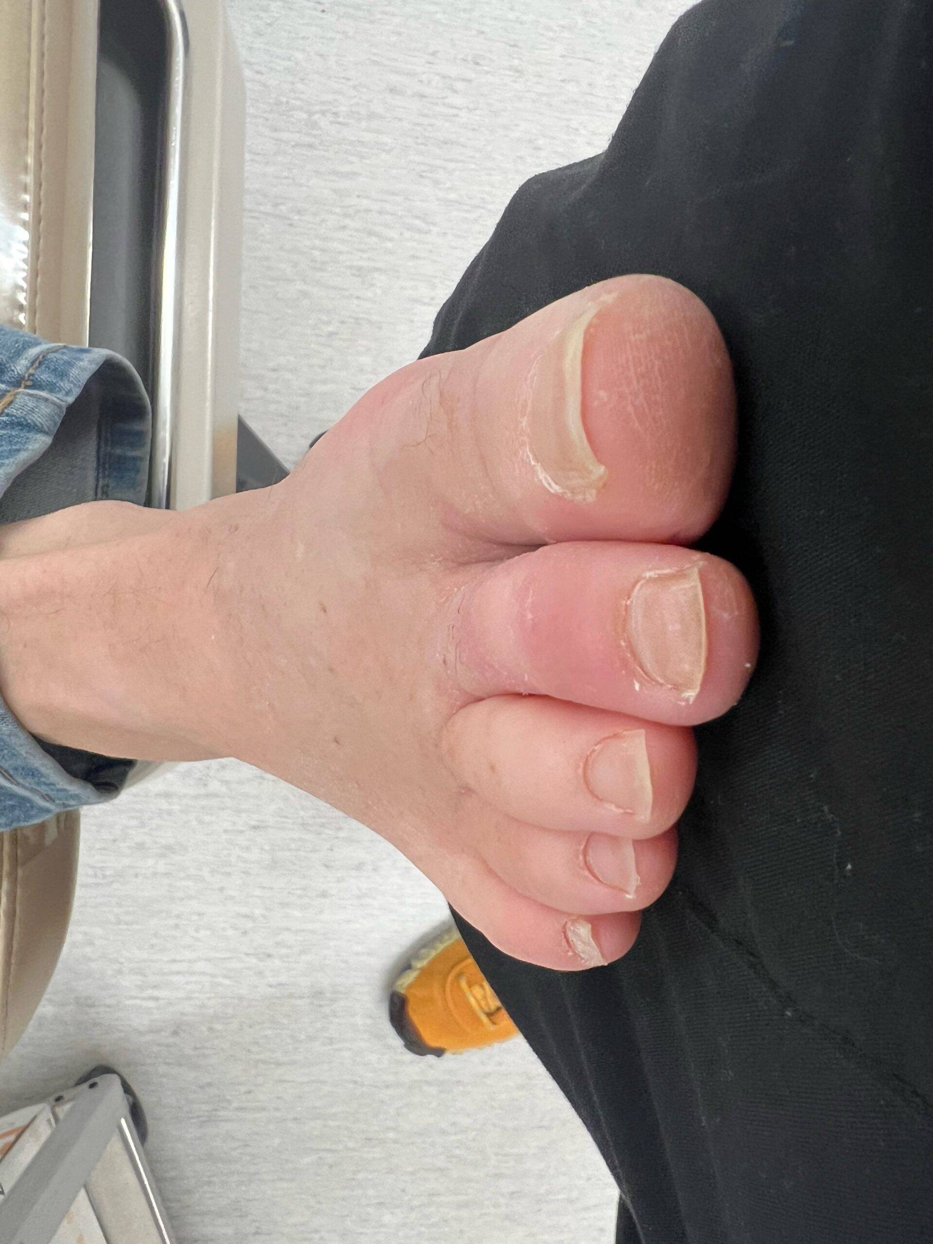 Hammertoe Before and After Photos | Northwest Surgery Center