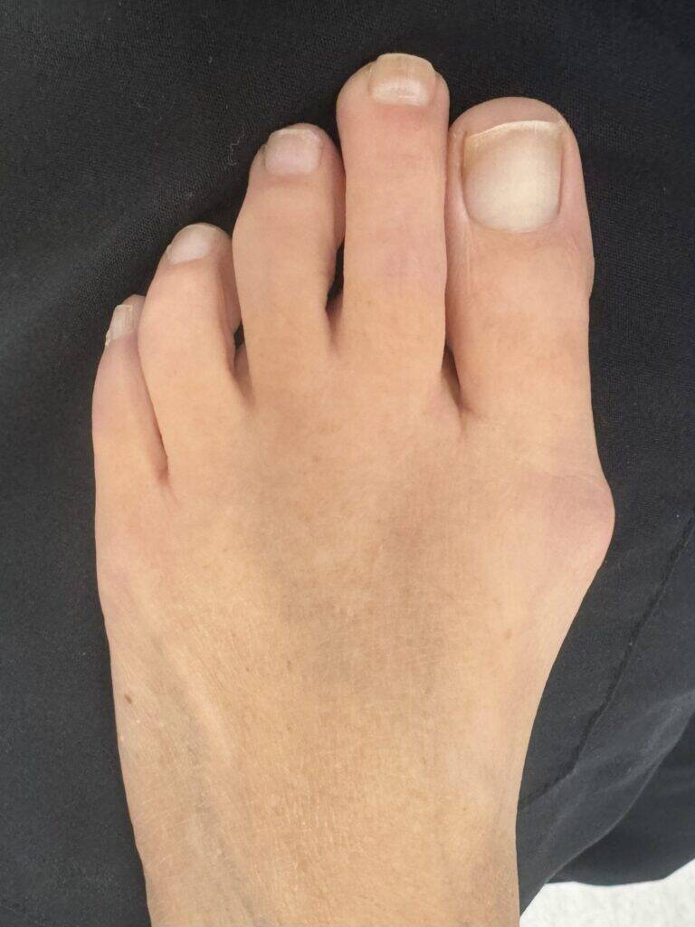 Bunion Surgery Before and After Photos | Northwest Surgery Center