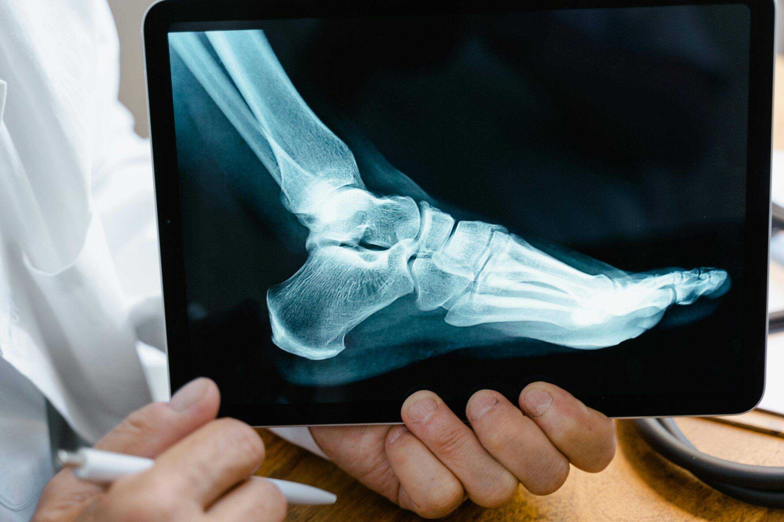 Types of Bunion Surgery: Which One Is Right for You?