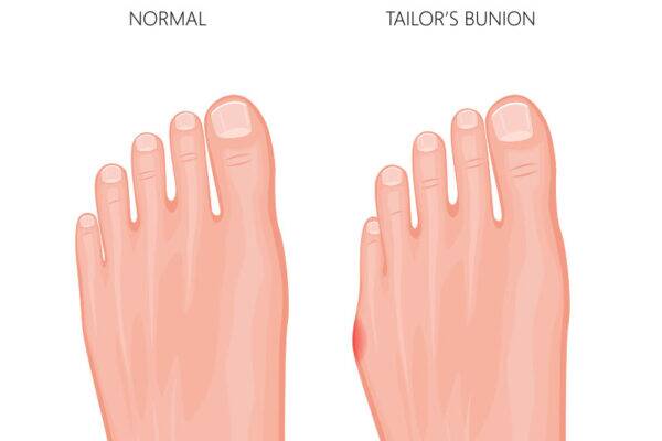 3 Common Tailor's Bunion Treatments | Northwest Surgery Center
